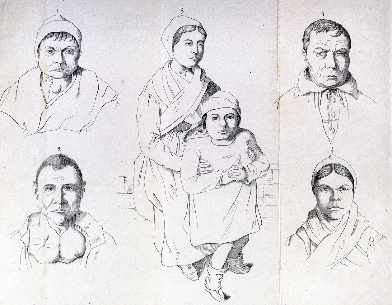 Morelによる風土病クレチン症の原因についての考察。